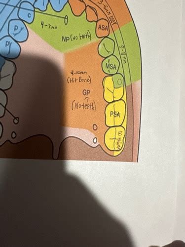 Anesthesia Ch 12 Maxillary Infiltrationfield Block Injections