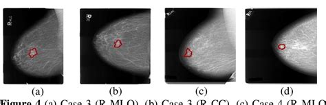 Figure From Exploring Breast Cancer Texture Analysis Through Multilayer Neural Networks