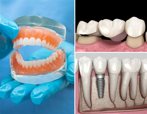 Tooth Replacement Options After A Tooth Extraction Monarch Dental Care
