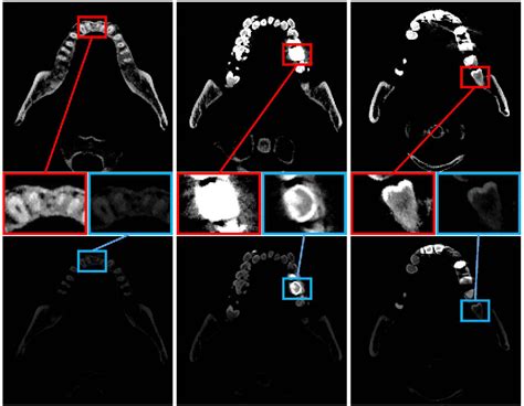 Figure 1 From Clinical Tooth Segmentation Based On Local Enhancement Semantic Scholar
