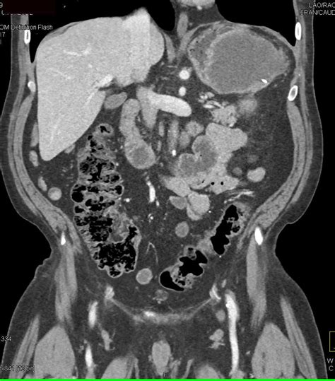 Gastric Gist Tumor Stomach Radiology Case Studies Ctisus Ct Scanning