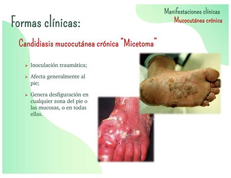 Candidiasis Pdf