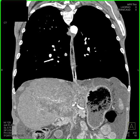 Central Cholangiocarcinoma With Vascular Invasion And Incidental Right Renal Cell Carcinoma