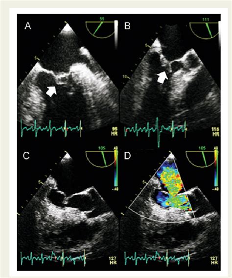 Figure 5 From Accessory Mitral Valve Tissue An Updated Review Of The