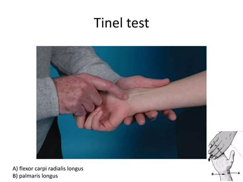 Median Nerve Palsy Final Pptx