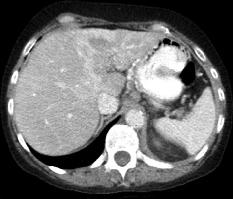 CT Abdomen Transverse Plane View 4 Months After ERCP Stent Placement Download Scientific