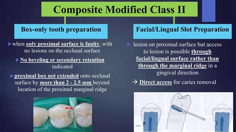 Class I Ii Composites Cavity Preparations Pptx