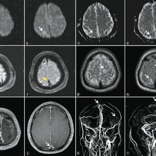 Diffusion Weighted MRI Showed Diffusion Restriction With High Signal Download Scientific