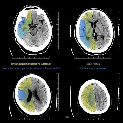 Clinical Presentation And Etiology Of Cerebral Venous Sinus Thrombosis