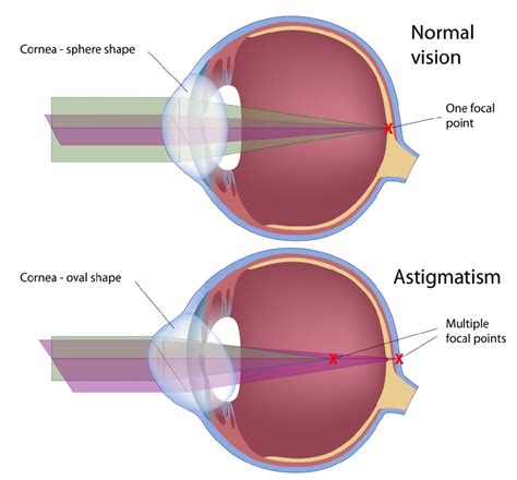 Astigmatism And How Visual Eyes Optometrists Can Help