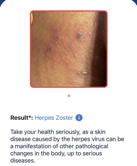 Rash Inner Buttocks Nsfw R Dermatologyquestions