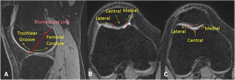 A Sagittal View Showing Separation Of Cartilage On The Femur Into Download Scientific Diagram