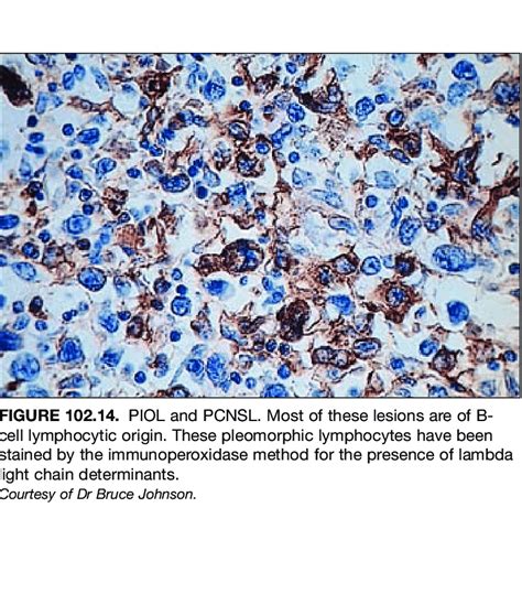 12 Piol Hyperchromatic Neoplastic Lymphocytes In The Vitreous Of A