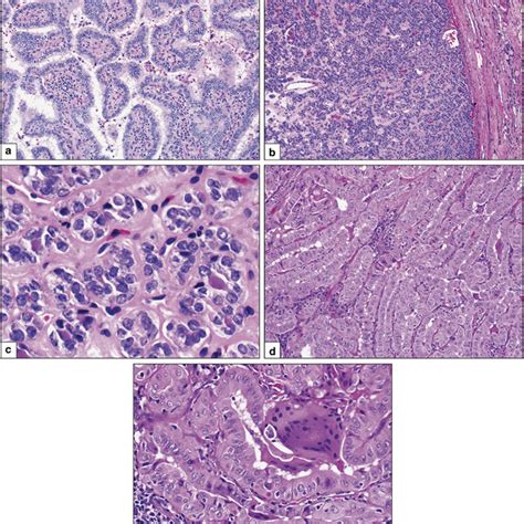 Papillary Thyroid Microcarcinoma A Classic Variant 7 Mm In A Download Scientific Diagram