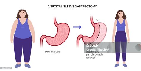 Laparoscopic Partial Gastrectomy Cpt Code
