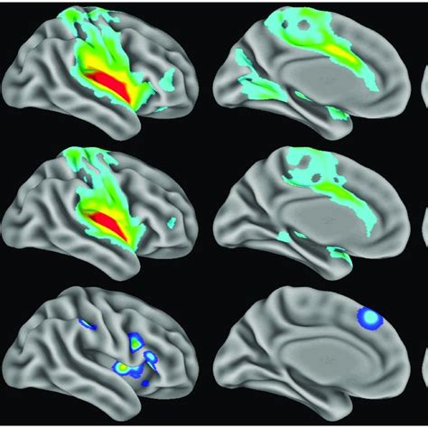 Resting State Functional Connectivity Networks Of The Posterior Insula