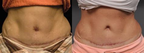 Appendicitis Scar Belly Button