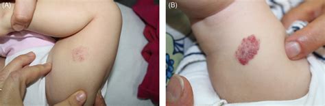 Topical Beta‐blockers In Dermatologic Therapy Pmc