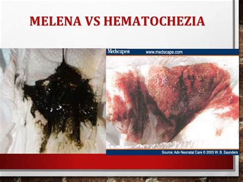 Hematoquezia Vs Melena Causes Of Hematemesis Melena And Rectorrhagia