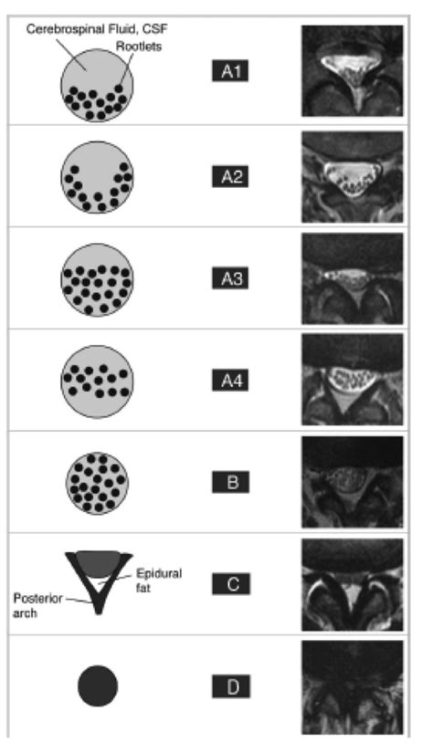 Rachis Lombaire Dégénératif Pinkybone