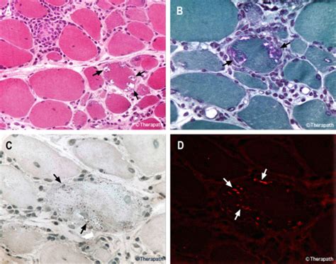 Muscle Biopsy Muscle Pathology Overview Therapath Neuropathology