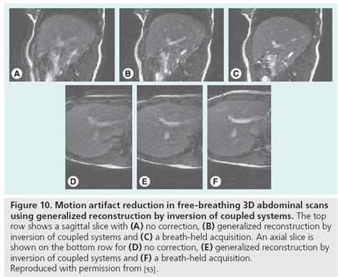 Mri Artifacts And Correction Strategies