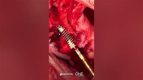 Squva Dr Alejandro Vivas Rojo Dentis Youtube