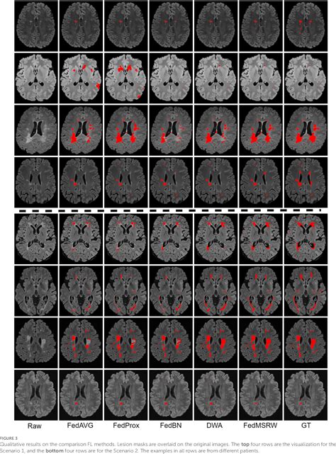 Figure 1 From Multiple Sclerosis Lesion Segmentation Revisiting