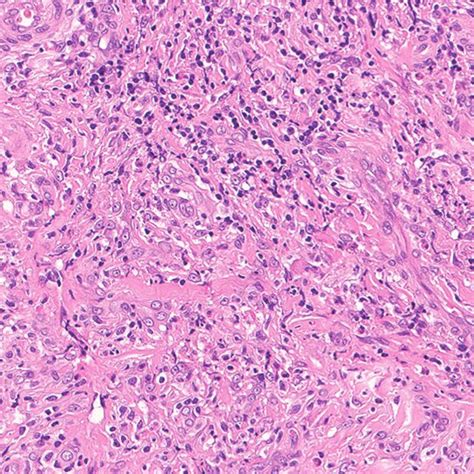 Clinical Presentation A Tender Mobile Subcutaneous Nodule On The Download Scientific Diagram