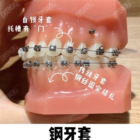 牙齿矫正器种类 有用 大山谷图库