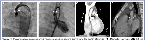 Congenital Supravalvular Aortic Stenosis Semantic Scholar
