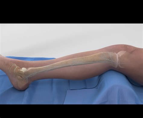 Video Curonix On Linkedin Ips Surgical Technique Animation Video