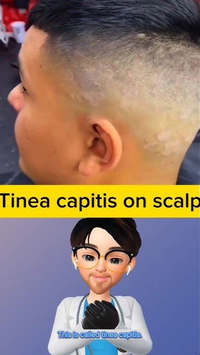 Tiña Capitis On Scalp Is Explained By Doctor I Doctor Doctor