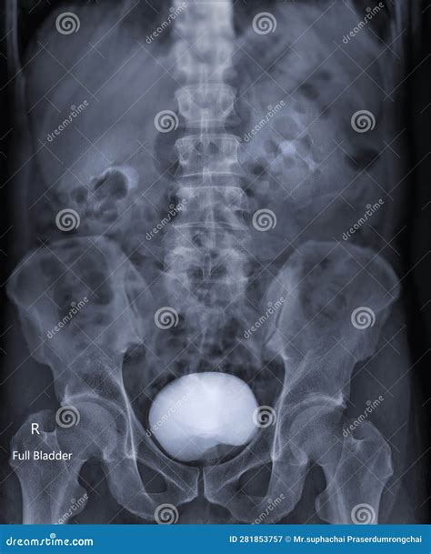 Intravenous Pyelogram Or I V P Stock Image Image Of Colic Adrenal 281853757