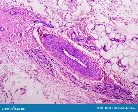 Prepatellar Region Histology Showing Bursitis Acute Or Chronic Bursitis Royalty Free Stock