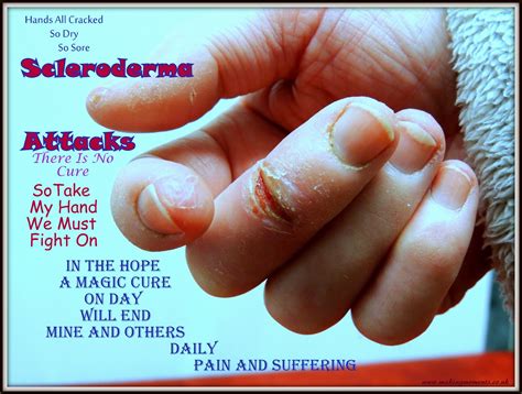Pictures And Poems Scleroderma Attacks
