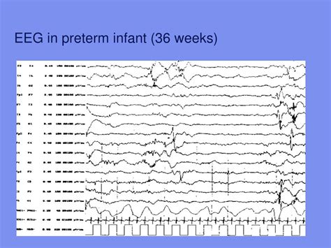 Ppt Cerebral Function Monitoring Amplitude Integrated Eeg Aeeg Denis Azzopardi Powerpoint