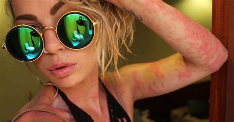 Model With Psoriasis Psoriasis Pictures PS Beauty