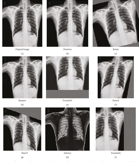 Figure 1 From Ai Assisted Tuberculosis Detection And Classification From Chest X Rays Using A