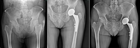 Pre And Postoperative X Ray Of A Patient With Femoral Neck Fracture