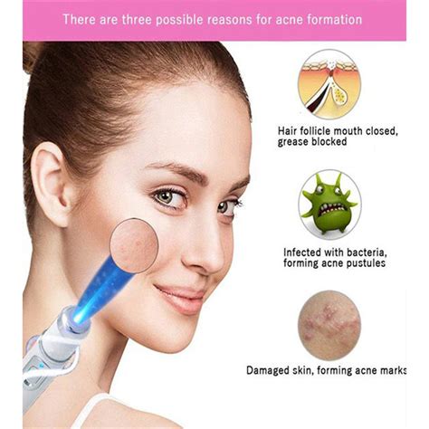 Badu Bg Лазерна писалка за премахване на бръчки от акне Премахване на петна по кожата