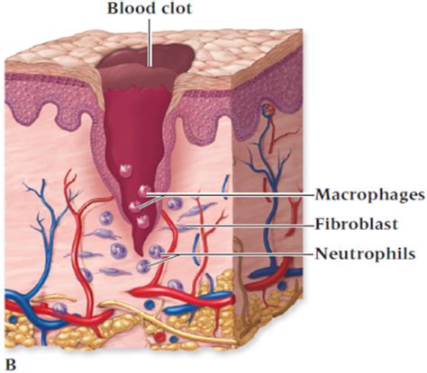 Chapter 10 Tissue Response To Injury Flashcards Quizlet