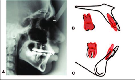 A Lateral X Ray And Superimposition Before And After Lower Anterior