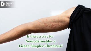 Neurodermatitis Causes Symptoms Treatment Prevention And Home Remedies
