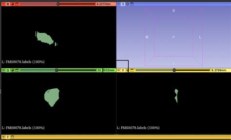 How To Calculate The Surface Area From 3d Fetal Mri Then Convert To