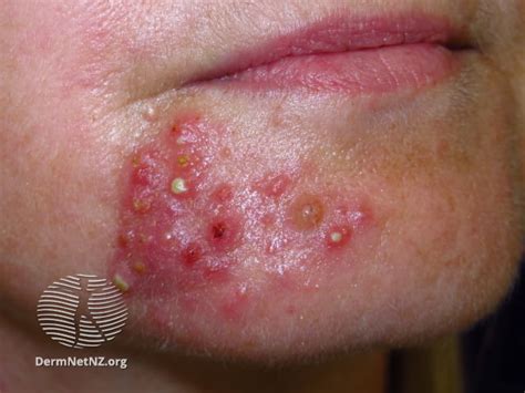 File Pyoderma Faciale Rosacea Fulminans Dermnet Nz Acne Pyofac 02  Nc Commons