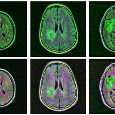 The Differences Of After Processed Used Clahe On The Dataset A