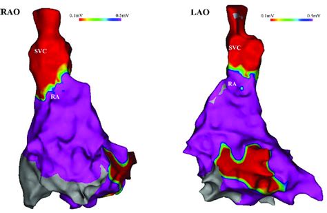 Three Dimensional Electroanatomical Right Atrial Voltage Map Carto3