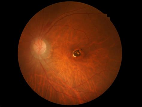 Gene Therapy Shows Promise Against Age Related Macular Degeneration