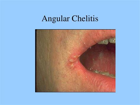 Ppt Common Opportunistic Infections In Hiv Patients Powerpoint Presentation Id5717662